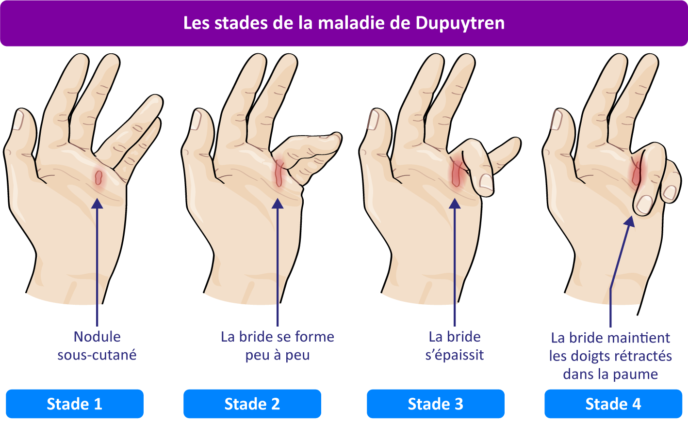 Maladie de Dupuytren - Réseau Main IDF